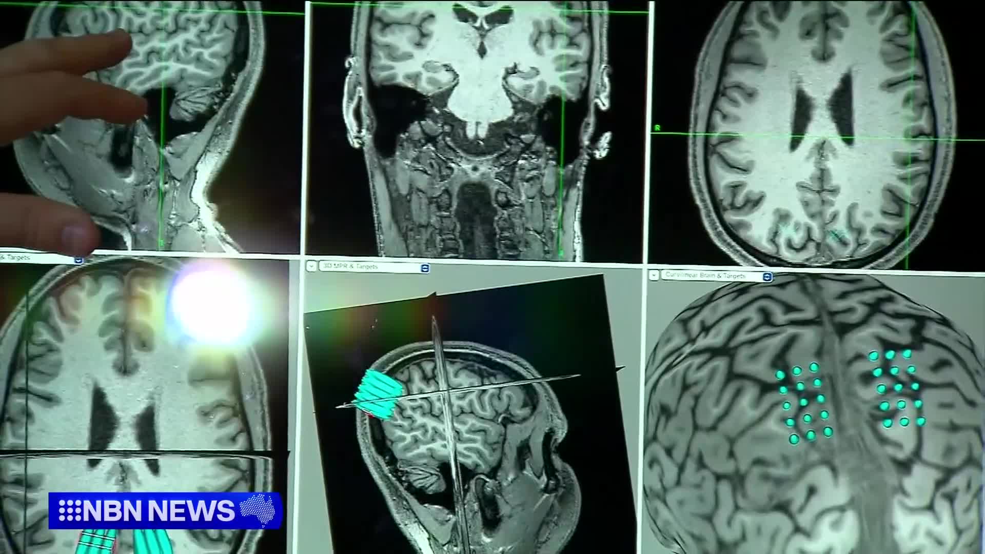 New Alzheimer’s therapy – NBN News